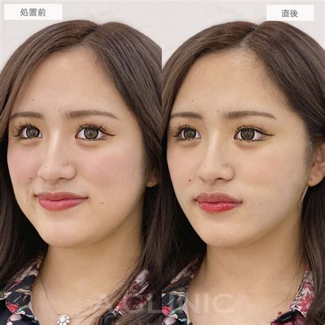 施術直後なのに腫れもなく小顔に！1day小顔脂肪吸引の処置前と直後の症例です20代女性 顔の脂肪吸引・糸リフト専門の美容整形クリニック