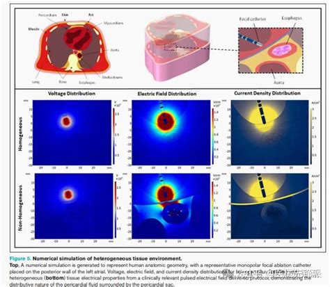 脉冲电场消融pfa入门 了解优势和局限 知乎