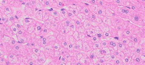 Human Liver Cancer Ffpe Sections