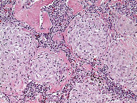Sarcoidosis Symptoms Treatments And Integrative Care Hss