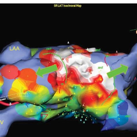 Wavefront Propagation Into Pulmonary Vein Antra Wavefront Propagation