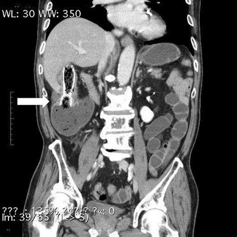Preoperative Abdominal Computed Tomography CT Findings An Abdominal