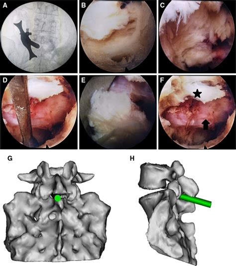 Percutaneous Endoscopic Lumbar Discectomy Via The Interlaminar Approach