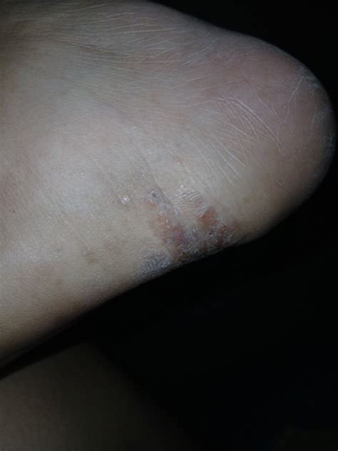 Gatal Gatal Yang Sembuh Timbul Hellosehat