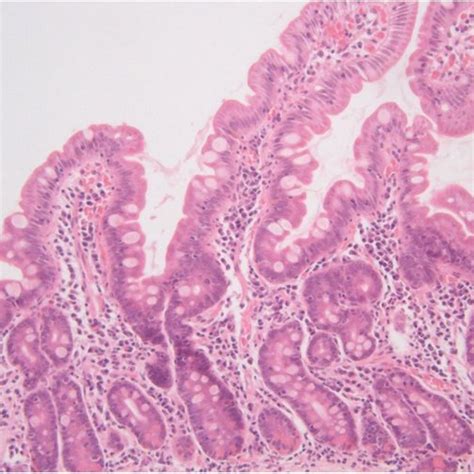 Multiple Crypt Apoptotic Bodies And Fragments Of Karyorrhectic Debris