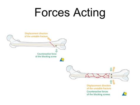 Poller Or Blocking Screw Ppt