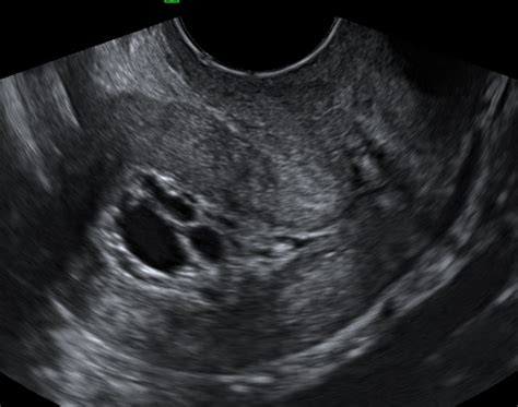 Normal Size Of Endometrium Postmenopausal At Milla Slessor Blog