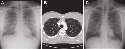 A Chest Radiograph Showing Diffuse Opacification And Increased Vascular