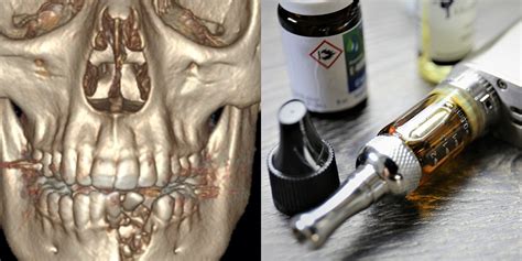 Teen Is Left With Severe Injuries After His Vape Pen Exploded In His Mouth