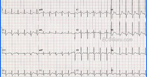 ECG Interpretation ECG Interpretation Review 72 Sinus Tachycardia In