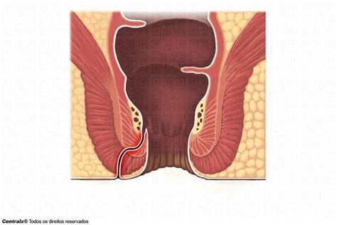 Farmale Achou Fístula Anal