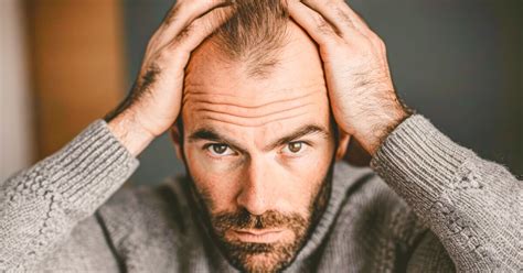 Tipos De Alopecia Y Sus Posibles Tratamientos • Instituto Dermatológico