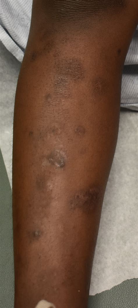 落叶性天疱疮 医学院