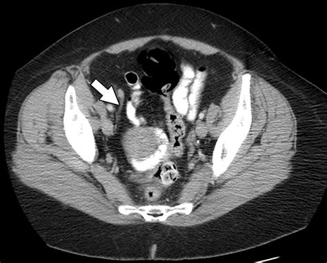 Positive Oral Contrast Solution At Mdct For Suspected Acute