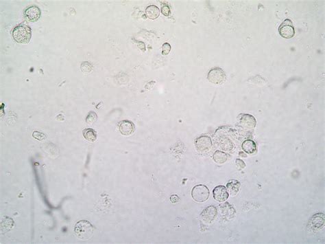 Urine Sediment Of The Month Dont Be Fooled By Decoy Cellsa Clue To