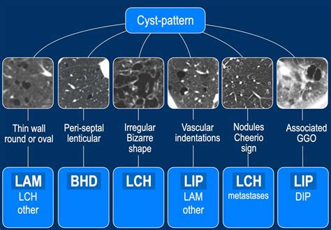 The Radiology Assistant Cystic Lung Disease Differential Diagnosis