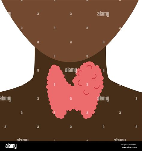 Enlarged Thyroid Gland On Black Neck Silhouette Stock Vector Image