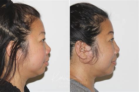 Submental Liposuction Photos Kam Facial Plastic Surgery