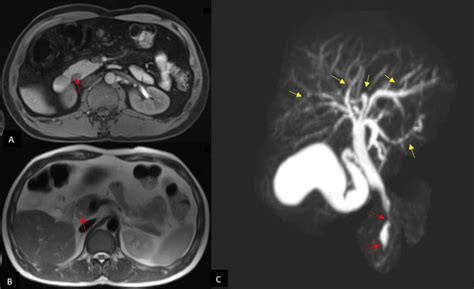 Axial T1 Noncontrast A And T2 B Weighted Mri Images Showing A
