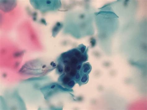 Ssch Cytologyclub On Linkedin Pap Smear Surepath™ For More