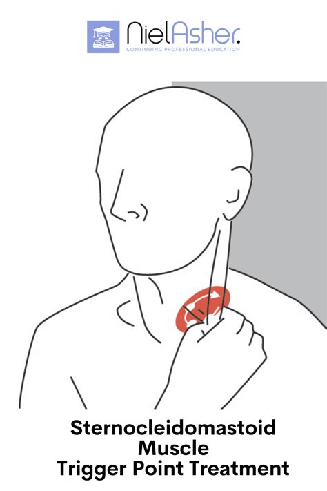 Trigger Point Therapy Treating Headaches Part 1 Artofit