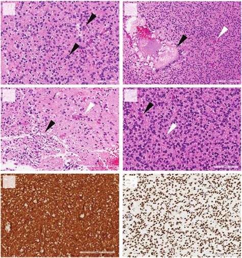 Histopathologic Features Of Tumor A Moderately Cellular Tumor With