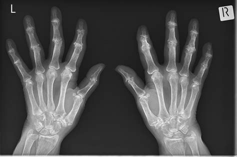 Psoriatic Arthritis Pencil In Cup