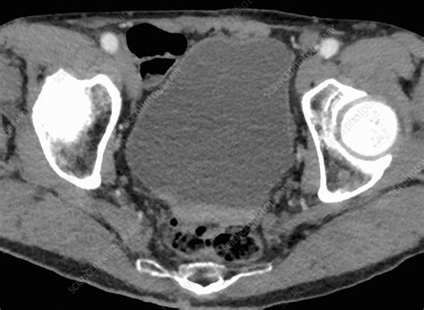 Bladder Cancer Ct Scan Stock Image C0213055 Science Photo Library