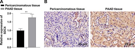 Sdc4 Expression In Paad And Corresponding Paracancerous Tissues A The Download Scientific
