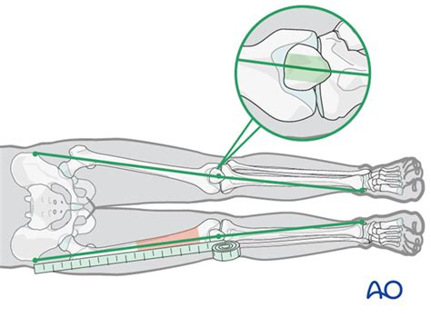 Traction For Extraarticular Fracture Simple