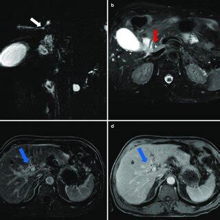 5 An Adult Female With Cholangitis Coronal MRCP A Image Showing Download Scientific Diagram