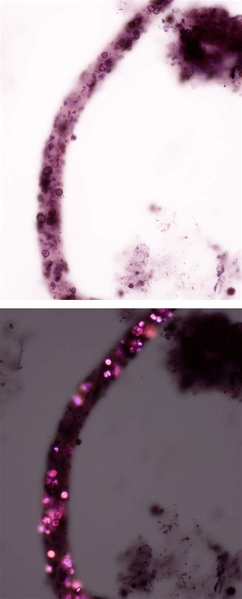Urine Sediment Of The Month Rbc Lookalikes Renal Fellow Network