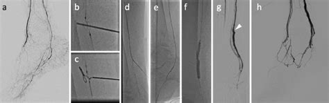 Figure8 PDVA Procedure Using VAST A Arteriogram Before PDVA B