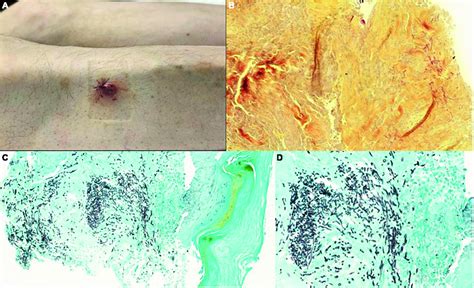 Painful Purplish Cutaneous Nodules A Pathology Examination With