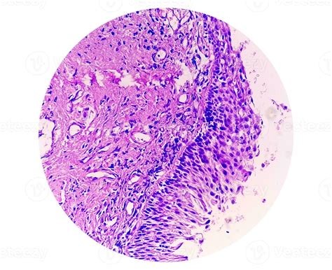 Histology Of Urachal Cyst Photomicrograph Of Histological Stained