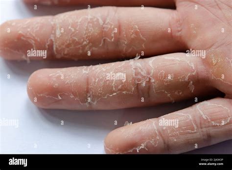 Finger Skin Peeling