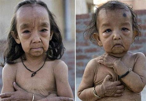 Progeria Sindrome Di Benjamin Button Cause Trasmissione Età Di