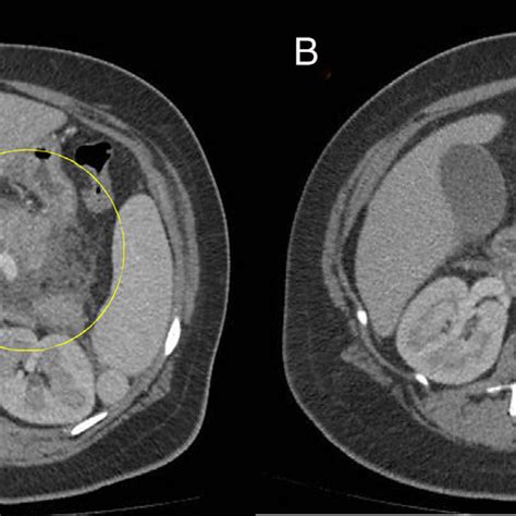 A And B The Image Shows The Edematous Pancreas With No Necrosis