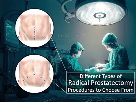 Different Types Of Radical Prostatectomy Procedures To Choose From By