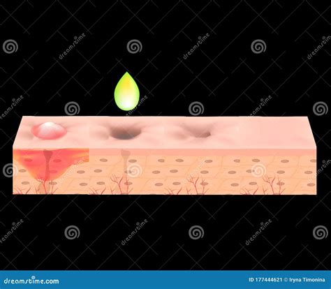 Atrophic Scars Acne Scar The Anatomical Structure Of The Skin With