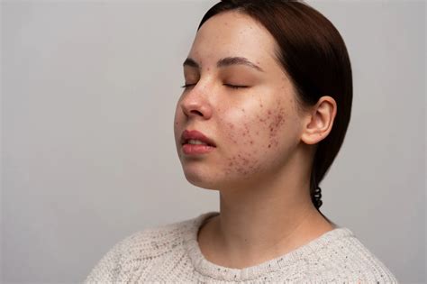 Best Acne Scars Treatment In Kolkata Cost Procedures And Results La