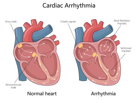 Effective Causes And Treatment For Heart Arrhythmia Cvg Cares