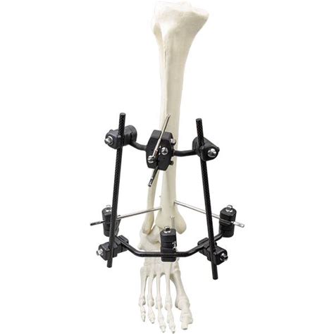 China Φ8 0 Series External Fixation Fixator Distal Tibia Semicircular Frame Factory And