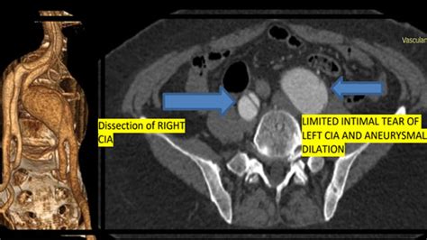 St Segment Elevation Myocardial Infarction Stemi