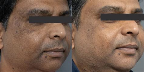 Laser Resurfacing Cutis Dermatology