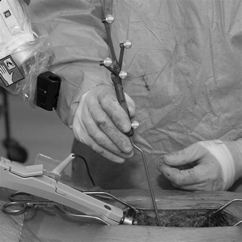 intra operative photo depicting the use of a passive planar probe to