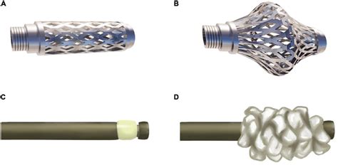 osseofix and sky bone expander a unexpanded osseofix b expanded