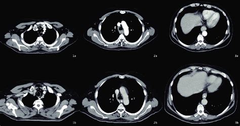 Double Contrasted Thoracic Ct Scan During The Hospitalization A And 4