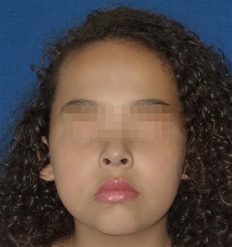 Rbcp Botulinum Toxin In The Treatment Of Asymmetric Crying Face
