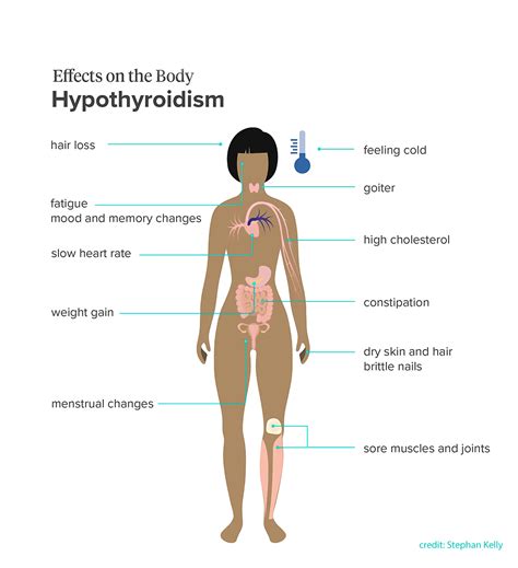 Hypothyroidism